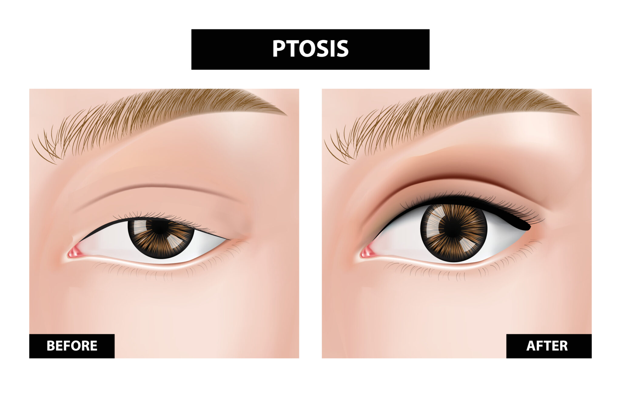 Does Blepharoplasty Effectively Treat Ptosis? | St. Luke's: Reflections